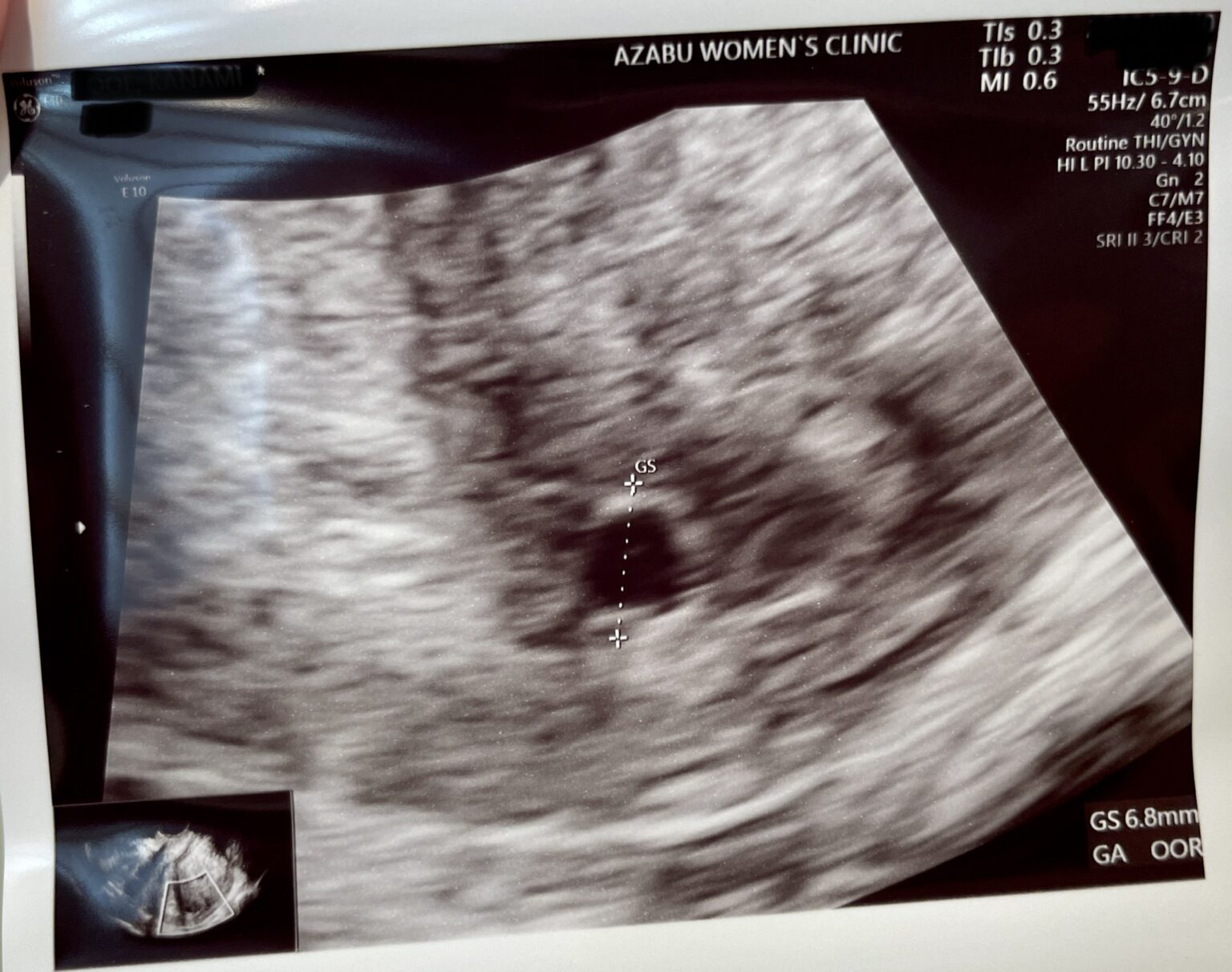 稽留流産（心拍確認後7w相当）した時のこと①【妊娠発覚～流産発覚】 | kanami blog