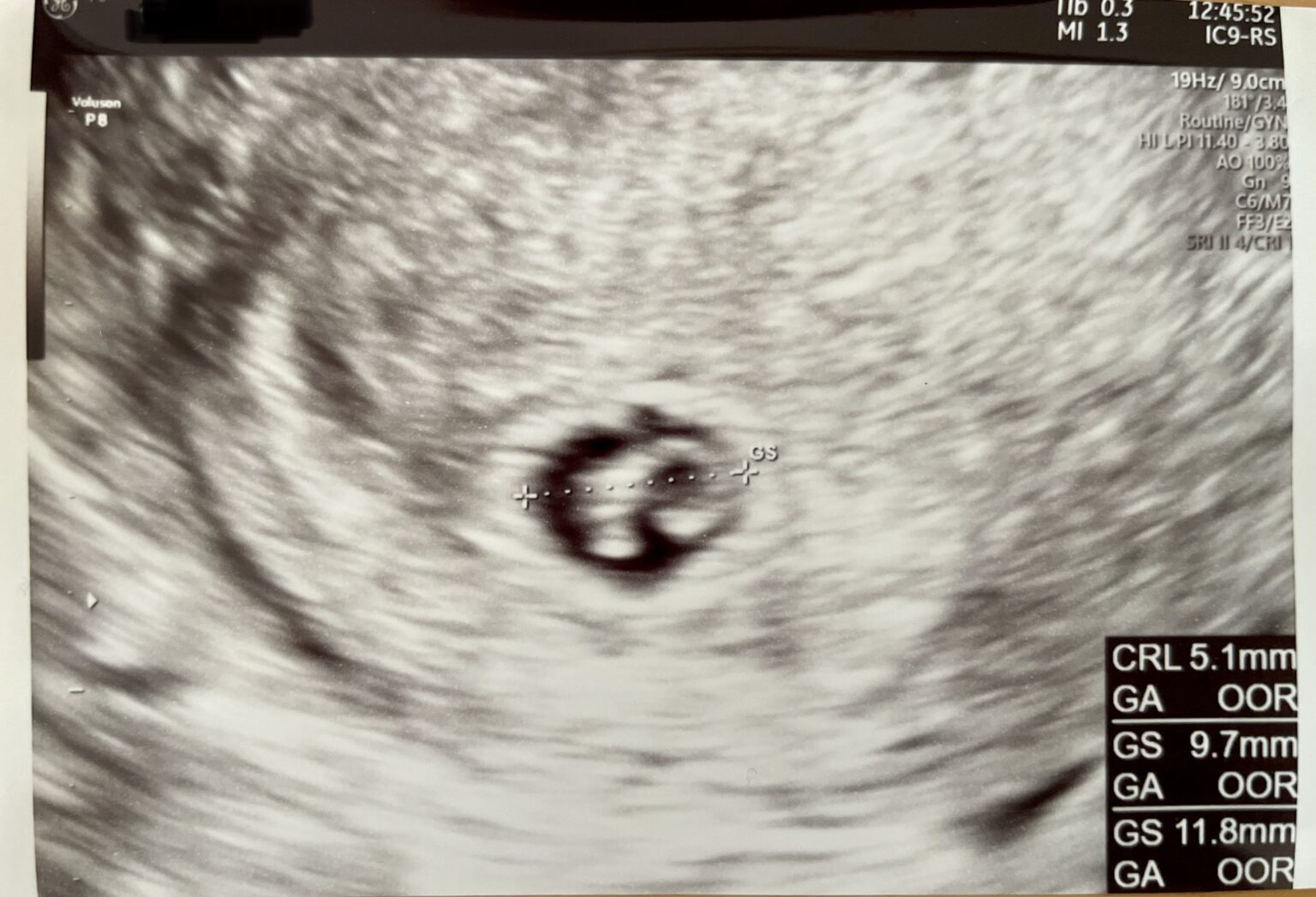 稽留流産（心拍確認後7w相当）した時のこと①【妊娠発覚～流産発覚】 | kanami blog