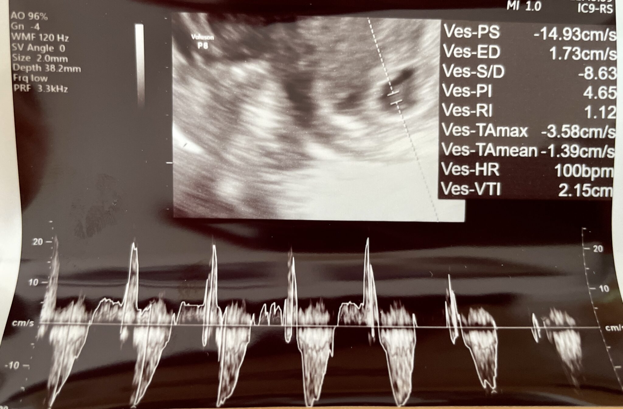 稽留流産（心拍確認後7w相当）した時のこと①【妊娠発覚～流産発覚】 | kanami blog